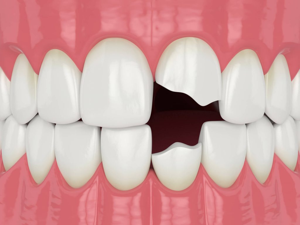 Tips to Prevent Cracked Teeth – Roosevelt Dental Center